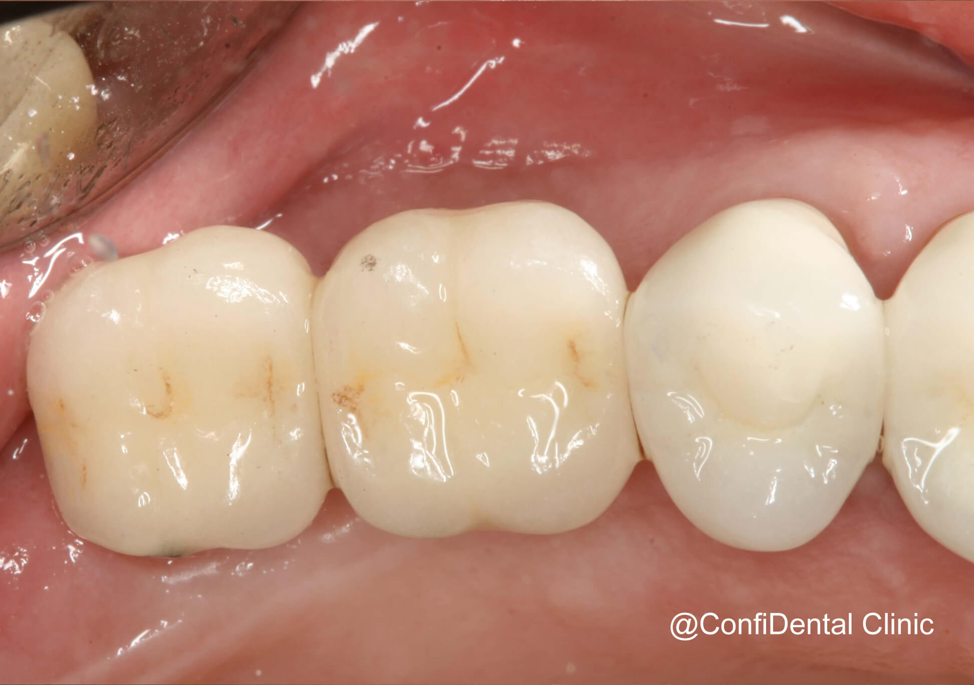 Dental Implant in Purley | Expert Implant Services | Confidental Clinic